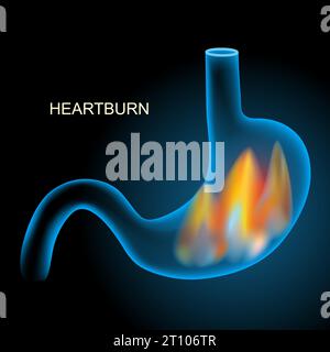 Esophageal gastric reflux acid indigestion. Gastrointestial stomach ...