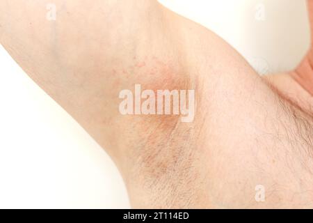 Allergy underarm. Cropped photo of irritation, inflammation on the ...