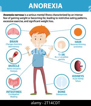Anorexia (Anorexia) and Its Effects on the Body illustration Stock Vector Image & Art - Alamy