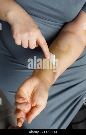 Bruise on a woman's arm, hematoma symptom of fragile capillaries and ...