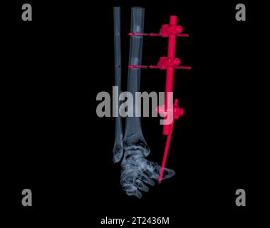 CT Scan ankle joint 3D Rendering image showing fracture tibia and ...
