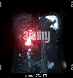 Magnetic resonance cholangiopancreatography or MRCP showing Gallbladder ...