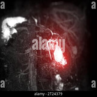 Magnetic resonance cholangiopancreatography or MRCP showing Gallbladder ...