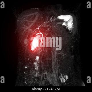 Magnetic resonance cholangiopancreatography or MRCP showing Gallbladder ...