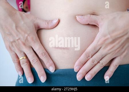 Close-up of scars after appendix surgery Stock Photo - Alamy