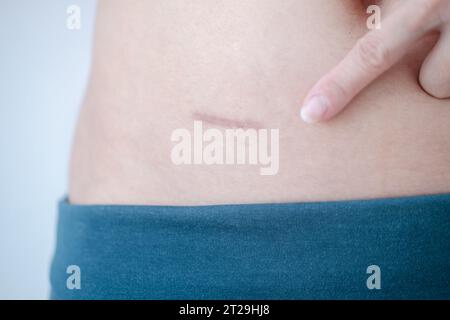Close-up of scars after appendix surgery Stock Photo - Alamy