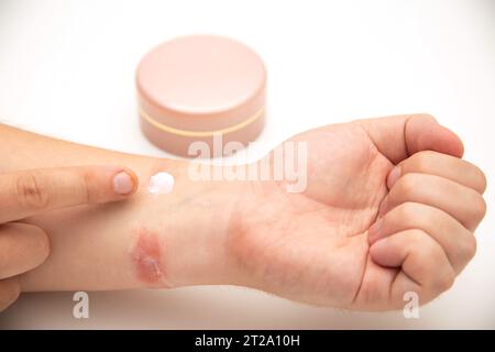 Contact dermatitis. Skin rash due to clothes rubbing against the ...