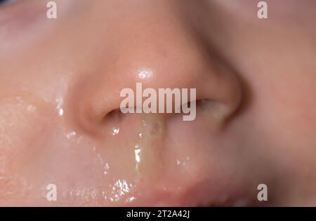 Face of a smiling baby boy with snot from his nose. Runny nose and ...