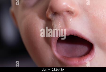 Yellow snot from a child s nose, close-up. Sinus infections, colds and ...