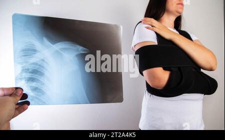 FRACTURED COLLARBONE, X-RAY Stock Photo - Alamy