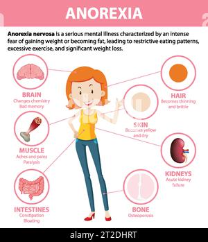 Anorexia (Anorexia) and Its Effects on the Body illustration Stock ...