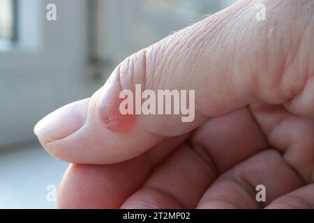 Hygroma (Ganglion cyst) of the thumb joint. Selective focus Stock Photo ...