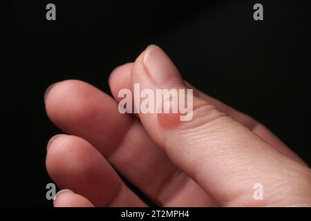 Hygroma (Ganglion cyst) of the thumb joint. Selective focus Stock Photo ...