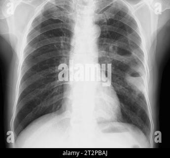 Lung abscess, X-ray Stock Photo - Alamy