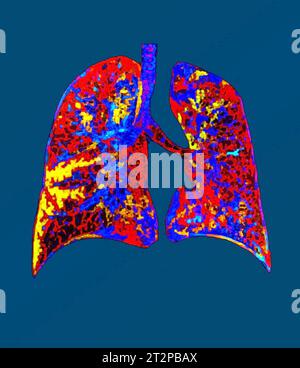 Normal lungs. Coloured computed tomography (CT) scan of a frontal ...
