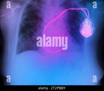 Heart pacemaker. Coloured chest X-ray showing a surgically-implanted ...