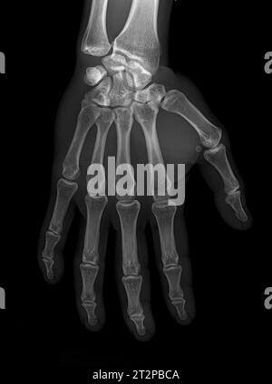 x-ray of a normal adult hand Stock Photo - Alamy