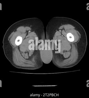 Prolapsed uterus, CT scan Stock Photo - Alamy