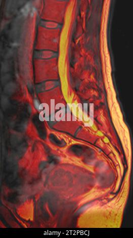 Magnetic Resonance Imaging MRI of the lumbosacral spine shows ...
