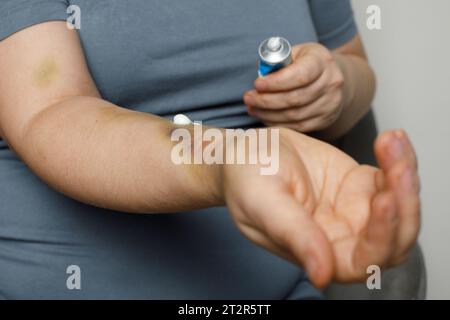 A very large bruise, contusion or hematoma on a woman's leg or thigh ...