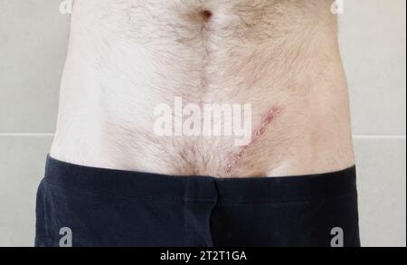 Hernia scar post operation on man Stock Photo - Alamy