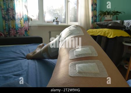 Leg with varicose veins close up Standing person with varicose veins in ...