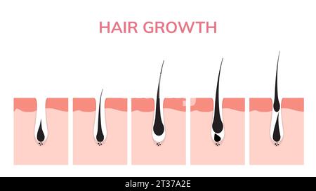 Hair growth cycle phases vector cross section infographics. Anagen ...
