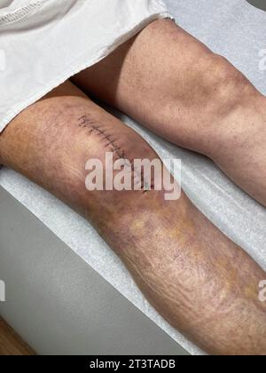 Scar after surgery on a woman shoulder on a red background Stock Photo ...