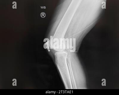 Medical x-ray of mid-adult woman's repaired patella Stock Photo - Alamy