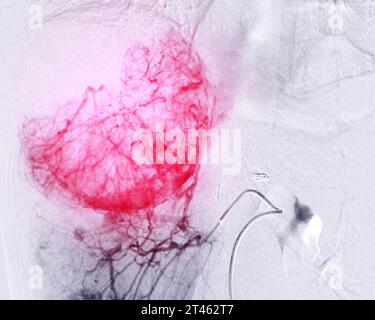 Transarterial Chemoembolization (TACE) is a medical procedure used to ...
