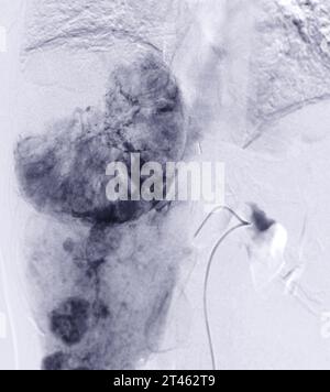 Transarterial Chemoembolization (TACE) is a medical procedure used to ...