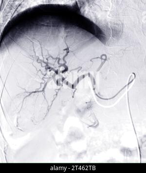Transarterial Chemoembolization (TACE) is a medical procedure used to ...