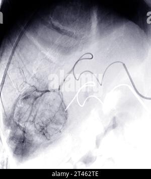 Transarterial Chemoembolization (TACE) is a medical procedure used to ...