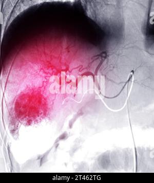 Transarterial Chemoembolization (TACE) is a medical procedure used to ...