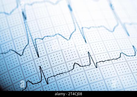 Electrocardiogram showing the pulse of the human heart Stock Photo - Alamy