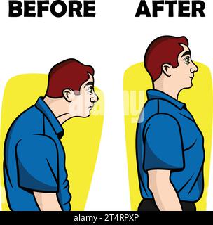 Standing man with incorrect spine posture. Spine health, bad body pose ...