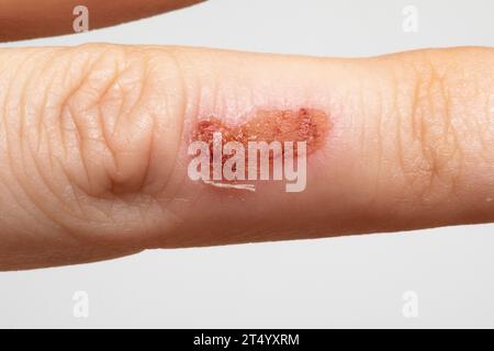 female hand with a scab due to impetigo, a contagious bacterial ...