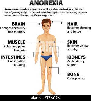 Illustration depicting the impact of Anorexia on various body functions Stock Vector Image & Art ...
