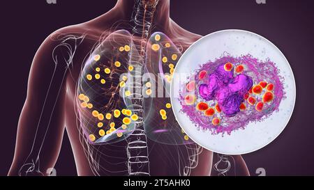 Lung histoplasmosis, a fungal infection caused by Histoplasma ...