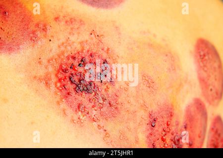 Skin disease - multiple herpes, closeup of photo Stock Photo - Alamy