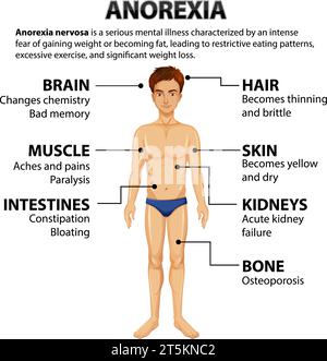 Illustration depicting the impact of Anorexia on various body functions Stock Vector Image & Art ...