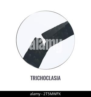 Trichoclasia hair brittle disorder in close up Stock Vector Image & Art ...