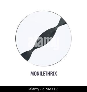 Monilethrix hair brittle disorder in close up Stock Vector Image & Art ...