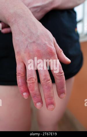 Foot of person with erythromelalgia, erythromelalgia flare up, skin ...