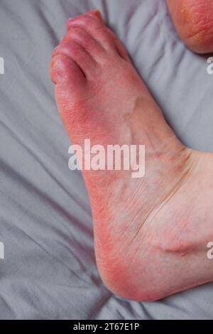 Foot of person with erythromelalgia, erythromelalgia flare up, skin ...