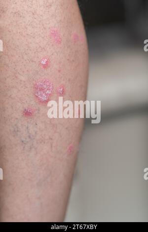 Psoriasis Vulgaris, skin patches are typically red, itchy, and scaly ...