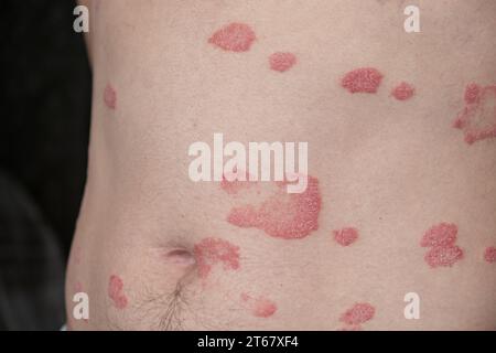 Psoriasis Vulgaris, skin patches are typically red, itchy, and scaly ...