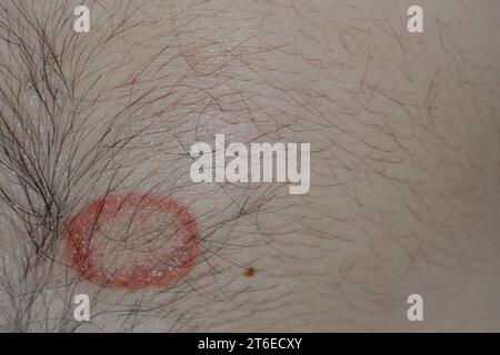 Detailed Close-Up of Ringworm (Tinea) Fungal Infection on Human Skin ...