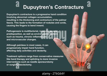 A 3D medical illustration displaying a patient's hand with Dupuytren's ...