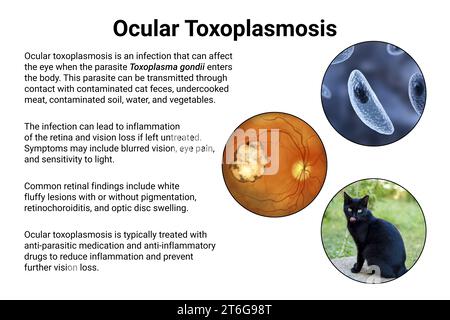 Ocular toxoplasmosis, a disease caused by the single-celled protozoan ...
